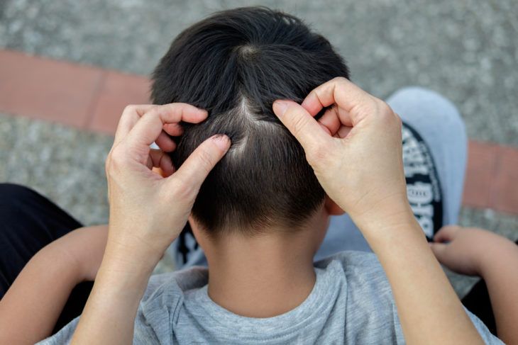 Signs That Your Child May Have Lice - ActiveBeat
