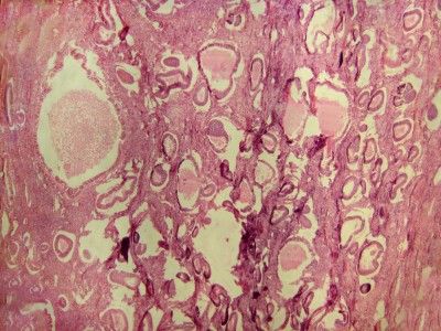 Les 8 Types de Polypes Les Plus Communs - ActiveBeat