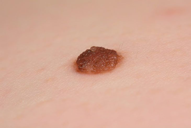 Signs of Abnormal Moles and When They Should Be Removed - ActiveBeat