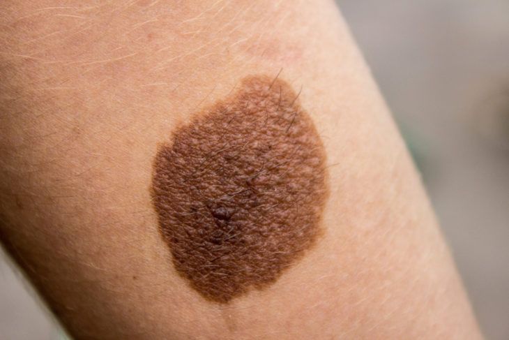Signs of Abnormal Moles and When They Should Be Removed - ActiveBeat