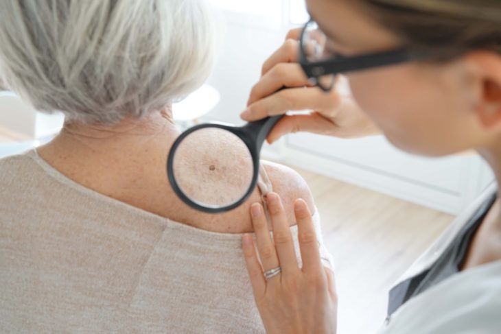 Signs of Abnormal Moles and When They Should Be Removed - ActiveBeat