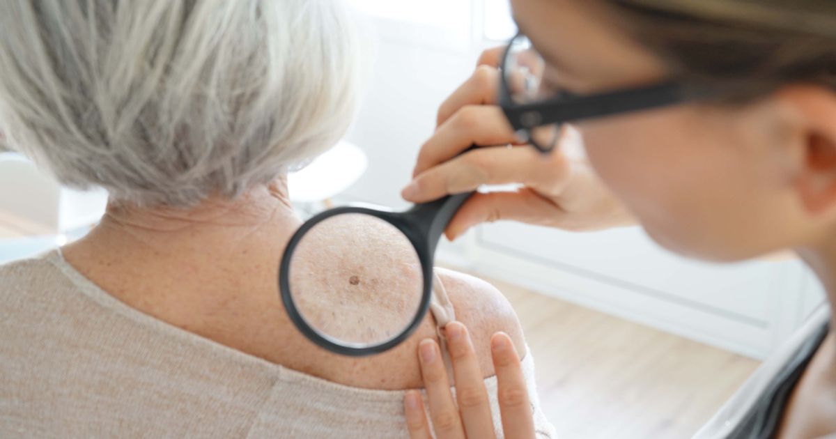 Signs of Abnormal Moles and When They Should Be Removed - ActiveBeat