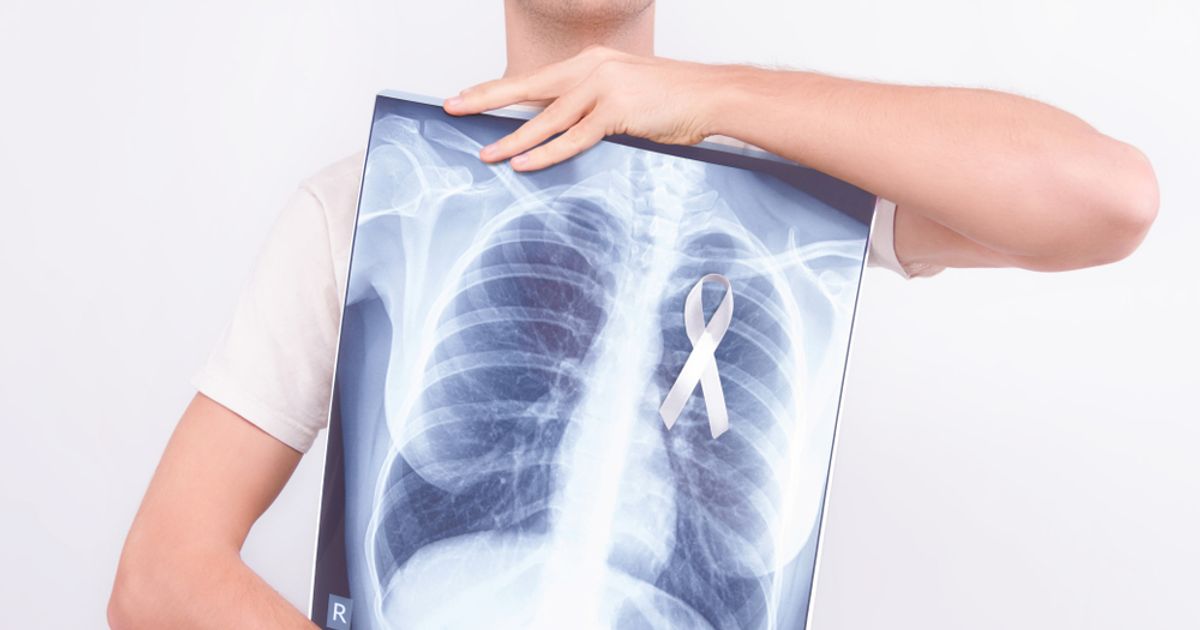 Lung Cancer: Early Signs and Symptoms - ActiveBeat