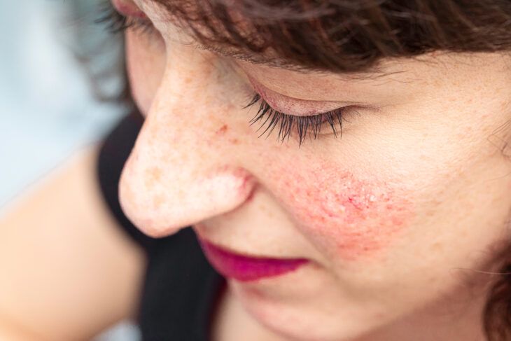 Common Symptoms of Rosacea - ActiveBeat