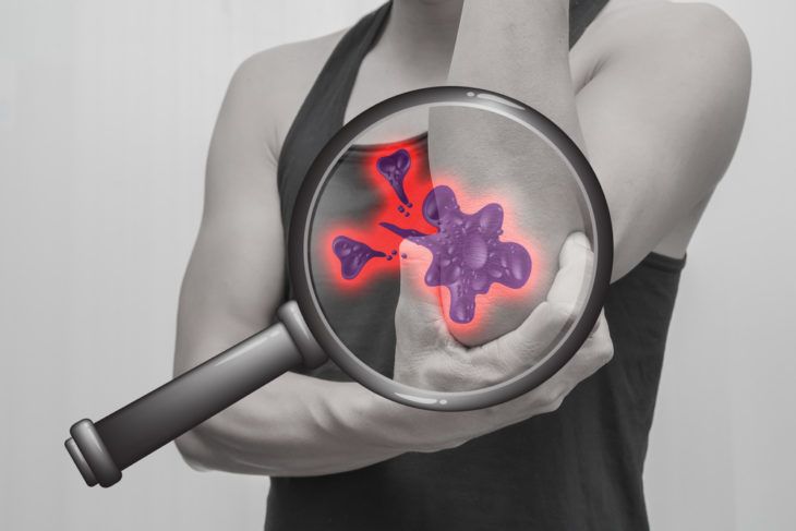 Common Signs, Symptoms, and Treatments For Bone Cancer - ActiveBeat