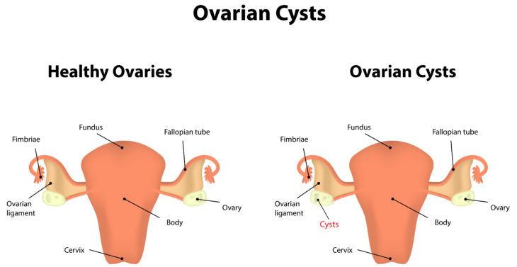 Common Causes of Feminine Pelvic Pain - ActiveBeat