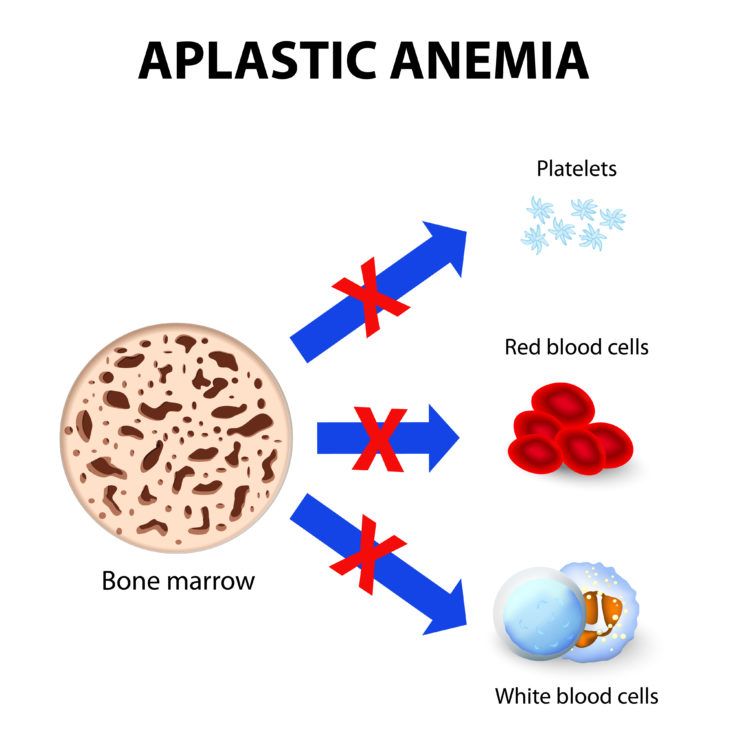 Most Common Types of Anemia - ActiveBeat