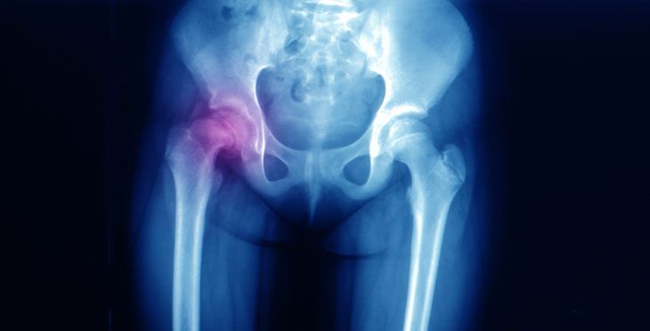 Common Causes of Hip Pain - ActiveBeat
