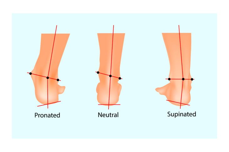 What Runners Should Know About Supination - ActiveBeat