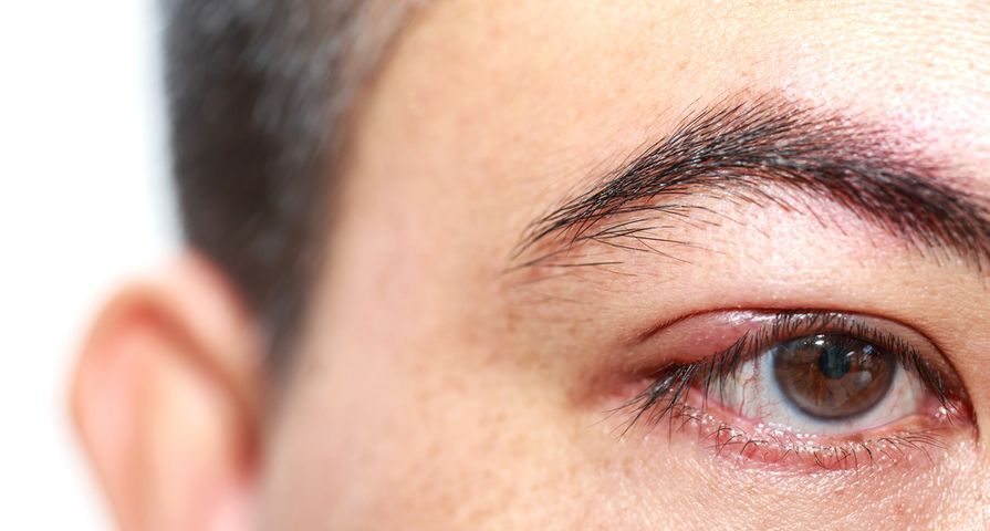 6 Eye-Opening Facts about a Sty - ActiveBeat