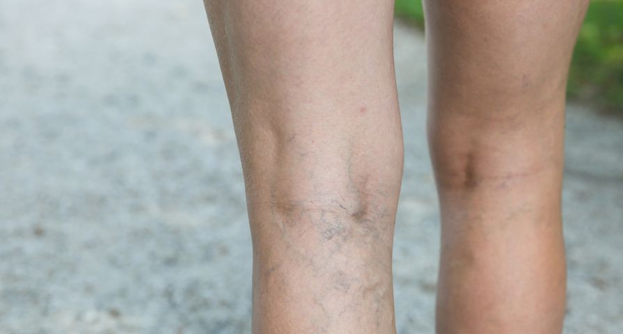 6 faits pour les femmes qui ont des varices - ActiveBeat