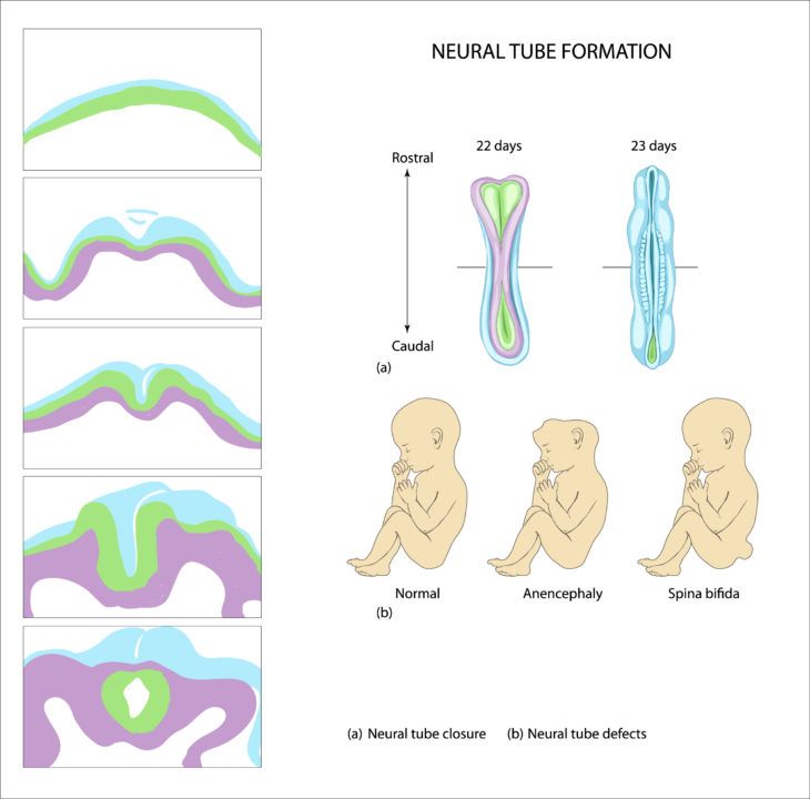 Facts on Spina Bifida Awareness - ActiveBeat