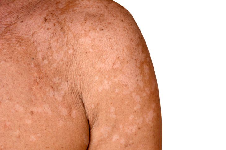 Skin Pigmentation Disorders - ActiveBeat