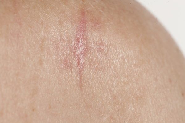 Signs and Symptoms of Non-Melanoma Skin Cancer - ActiveBeat