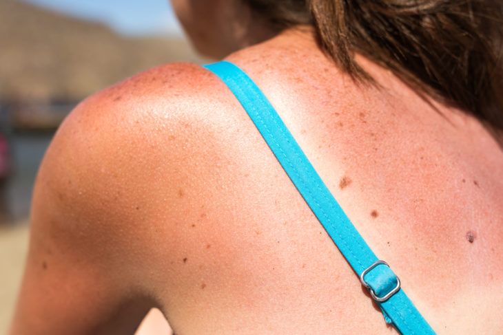 Signs and Symptoms of Non-Melanoma Skin Cancer - ActiveBeat