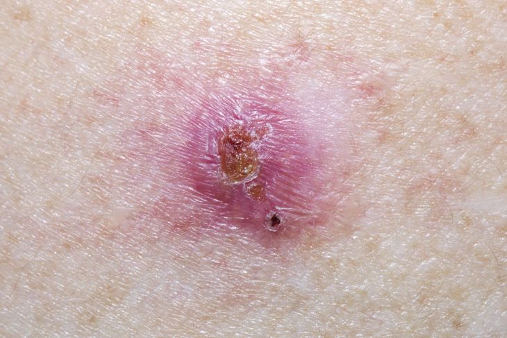 Signs of Abnormal Moles and When They Should Be Removed - ActiveBeat