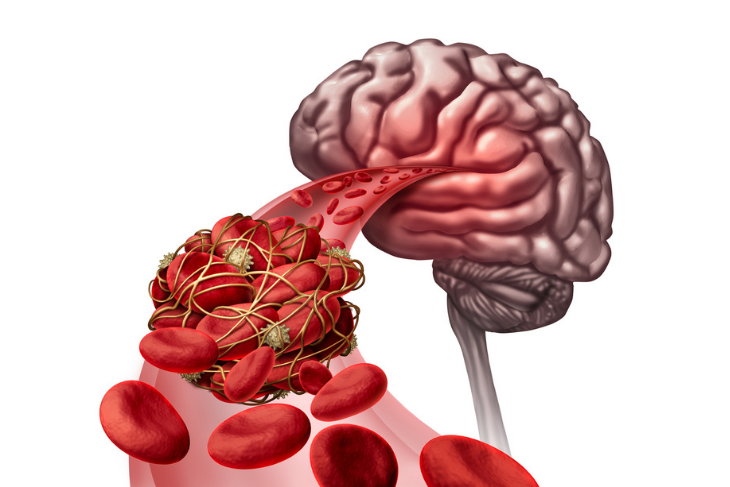 What to Know About Blood Clotting Disorders in Children - ActiveBeat