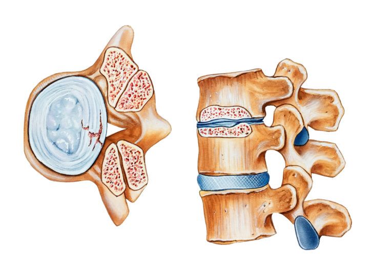 Most Common Causes and Risk Factors of Spinal Stenosis - ActiveBeat