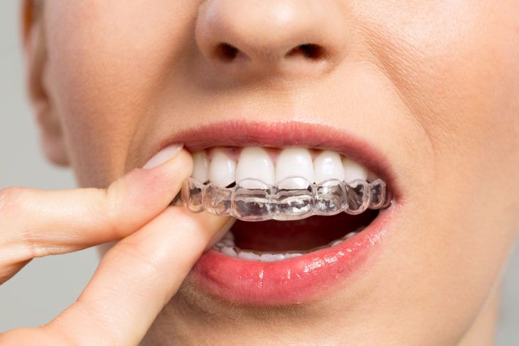 Tips Every Patient Should Know About Invisalign Braces - ActiveBeat