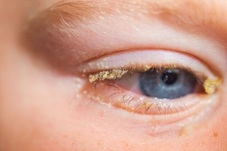 Itchy, Scratchy, Uncomfortable Symptoms of Pink Eye - ActiveBeat