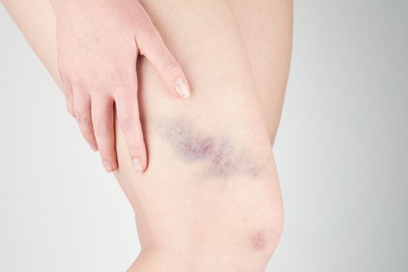 Common Signs and Symptoms of a Blood Clot - ActiveBeat