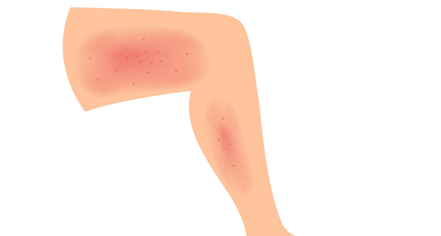 Cellulitis: Symptoms, Causes, and Treatment Options - ActiveBeat