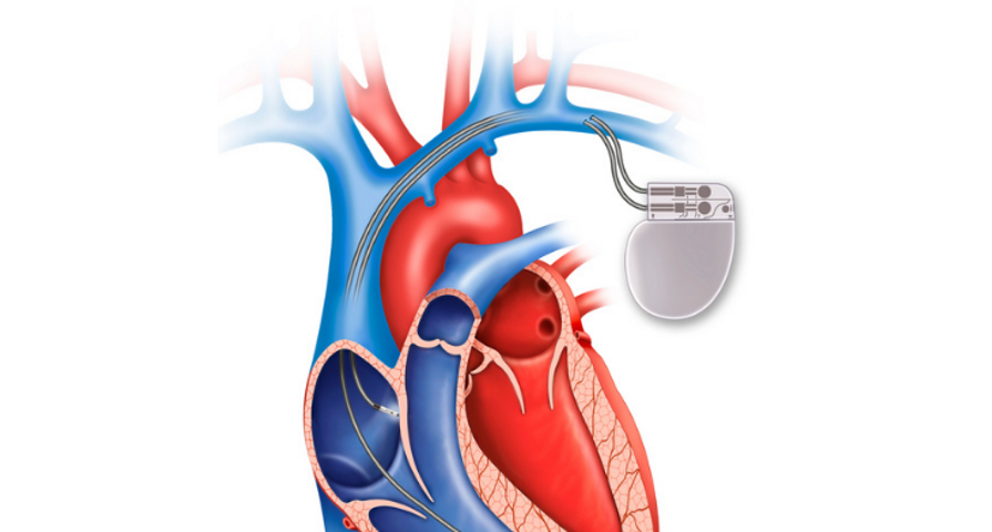 A Complete Guide to Living With a Pacemaker - ActiveBeat