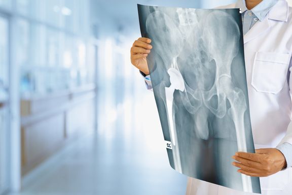 Early Signs of Osteopenia - ActiveBeat